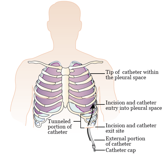 About Your PleurX™ Catheter | Memorial Sloan Kettering Cancer Center