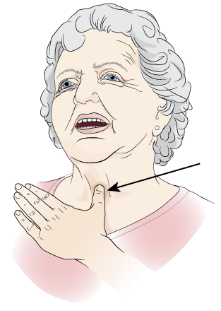 About Your Total Laryngectomy | Memorial Sloan Kettering Cancer Center