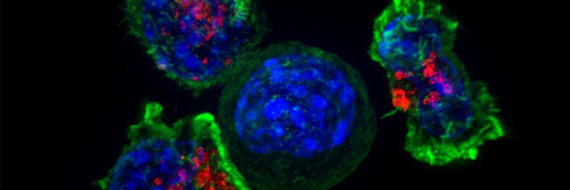 Synovial Sarcoma | Memorial Sloan Kettering Cancer Center