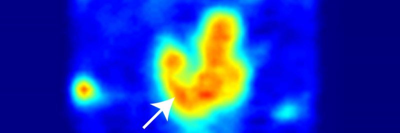 PSA Test for Prostate Cancer | Memorial Sloan Kettering Cancer Center